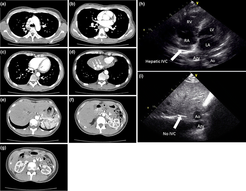 Atrial tachycardia originating from the hepatic segment of inferior ...