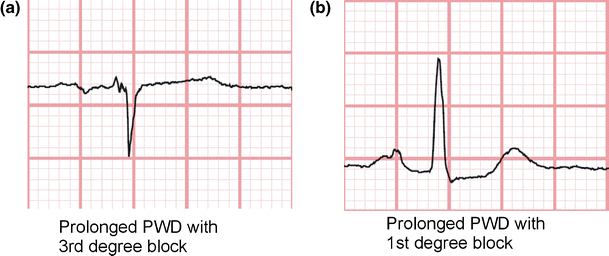 Prolonged P-wave duration is associated with atrial fibrillation ...