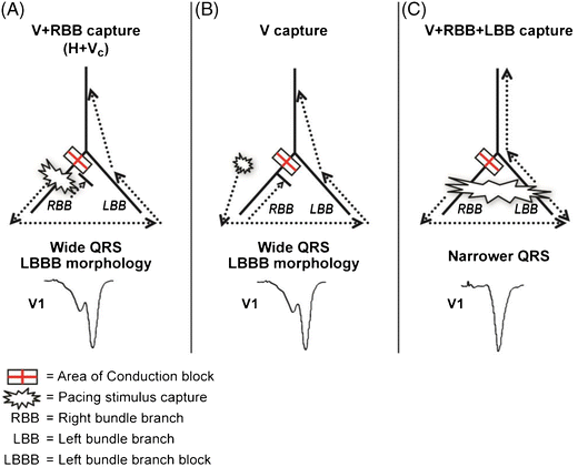 Parahisian pacing: technique, utility, and pitfalls | SpringerLink