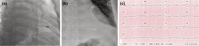 Direct electrical shock on a leadless pacemaker | SpringerLink