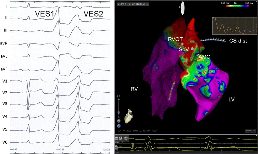 Left ventricular outflow tract arrhythmias with divergent QRS ...