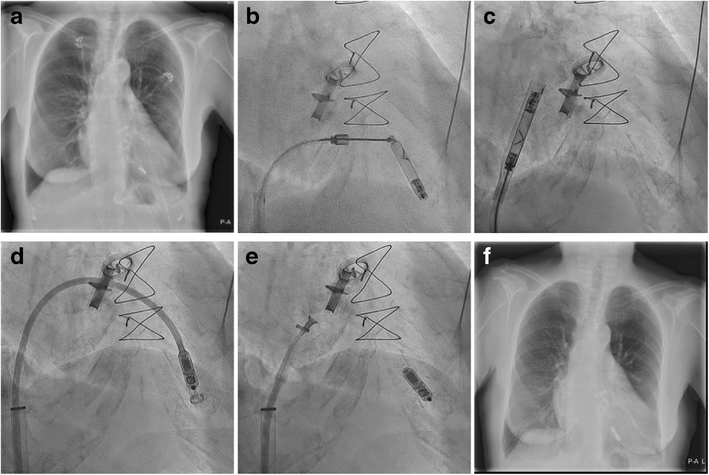 Successful replacement of the longest worldwide in situ Nanostim ...