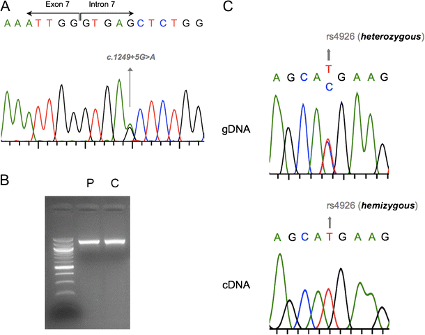 A Novel Splice Site Mutation in the SERPING1 Gene Leads to ...