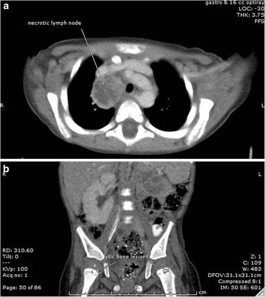 Disseminated Mycobacterium kansasii Disease in Complete DiGeorge ...