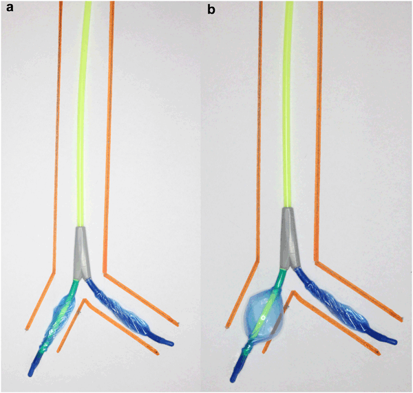 Comparison of Univent tube and EZ blocker in one lung ventilation ...