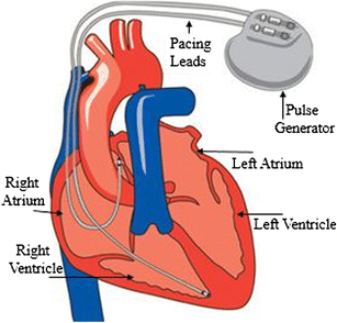 From Pacemaker to Wearable: Techniques for ECG Detection Systems ...