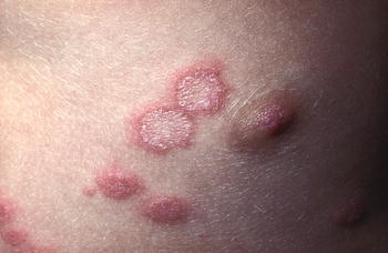 Clinical Forms of Dermatophytosis (Ringworm Infection) | SpringerLink