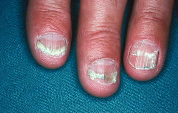 Clinical Forms of Dermatophytosis (Ringworm Infection) | SpringerLink