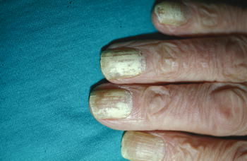 Clinical Forms of Dermatophytosis (Ringworm Infection) | SpringerLink