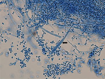 Trichophyton erinacei Infection from a Hedgehog: A Case Report from ...