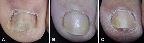 Onychomycosis Due to Neoscytalidium Treated with Oral Terbinafine ...