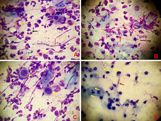 Clinical and Laboratory Features of Six Cases of Candida and ...