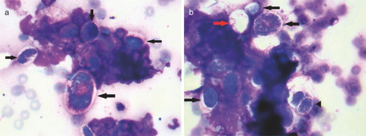 Evidence of a Prototheca Zopfii Genotype 2 Disseminated Infection in a ...