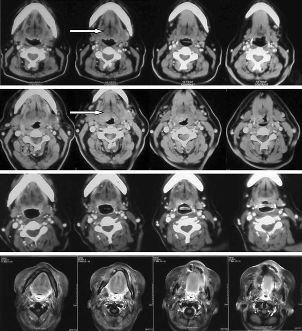 Anti-CV2 associated cerebellar degeneration after complete response to ...