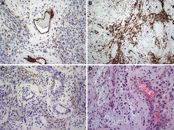 Primary gliosarcoma: key clinical and pathologic distinctions from ...
