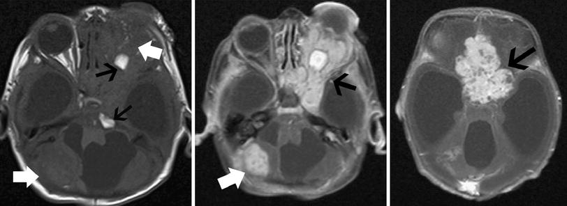 Intracranial Masson tumor: case report and literature review | SpringerLink