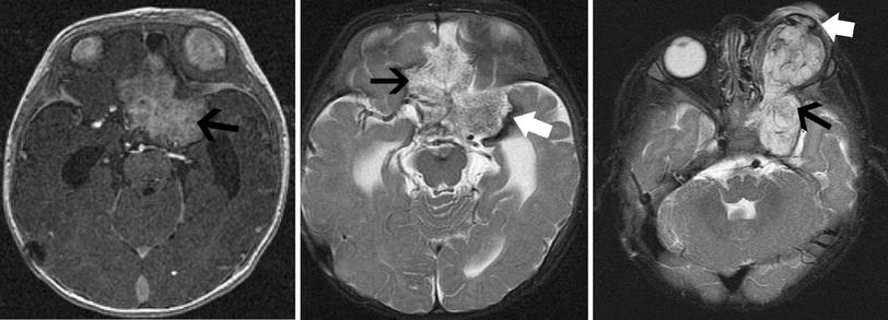 Intracranial Masson tumor: case report and literature review | SpringerLink