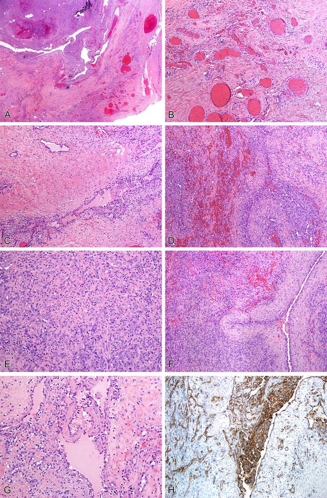 Intracranial Masson tumor: case report and literature review | SpringerLink