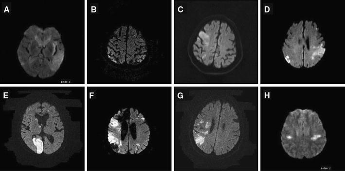 Clinical manifestation of cancer related stroke: retrospective case ...