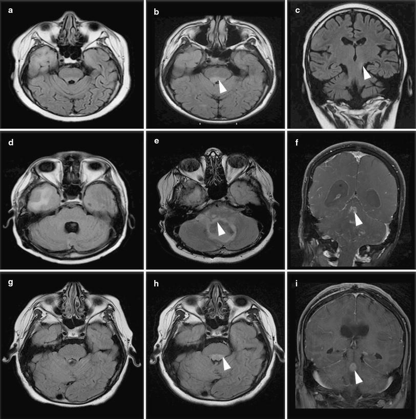 Bilateral internuclear ophthalmoplegia associated with pediatric brain ...