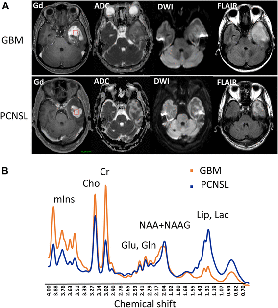 Myo-inositol concentration in MR spectroscopy for differentiating high ...
