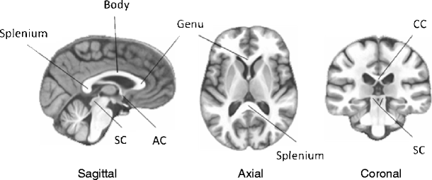 Contribution of Callosal Connections to the Interhemispheric ...
