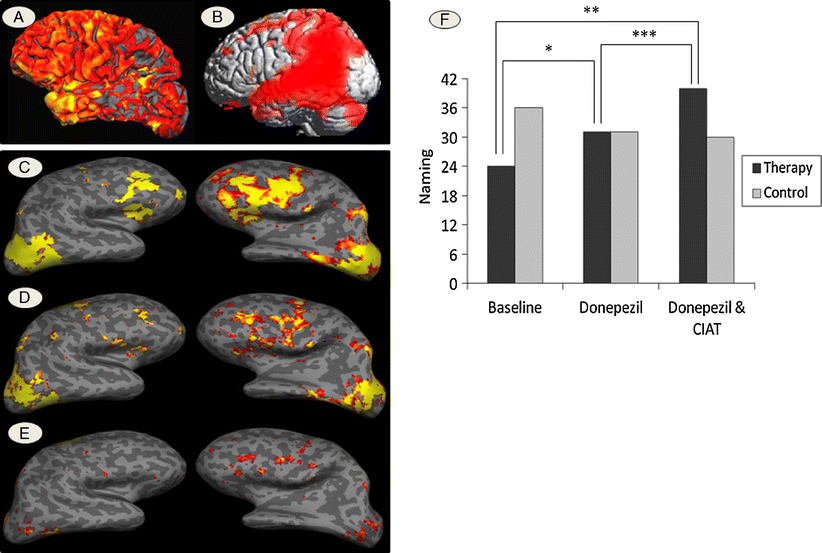 Drug Therapy of Post-Stroke Aphasia: A Review of Current Evidence ...