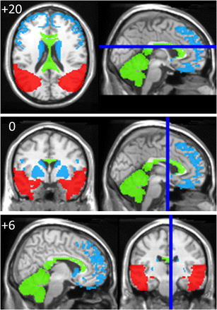 A Comparison of Structural Brain Imaging Findings in Autism Spectrum ...