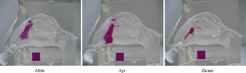 Assessment of Nasal Spray Deposition Pattern in a Silicone Human Nose ...