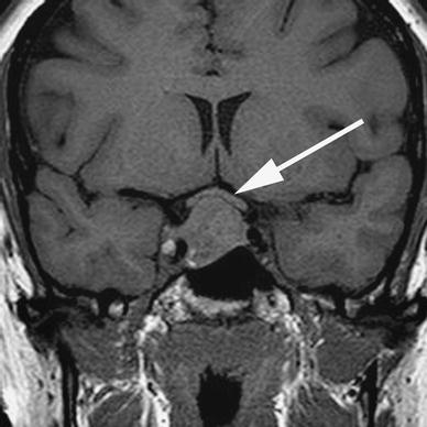 Transsphenoidal surgery | SpringerLink