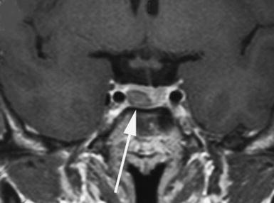 Transsphenoidal surgery | SpringerLink