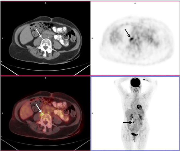 Endovascular infection following inferior vena cava (IVC) filter ...