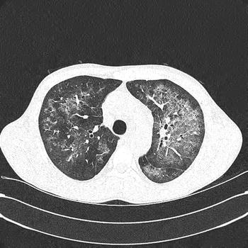 Bronchiolitis obliterans organizing pneumonia (BOOP) after renal ...