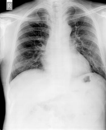 Bronchiolitis obliterans organizing pneumonia (BOOP) after renal transplantation | SpringerLink