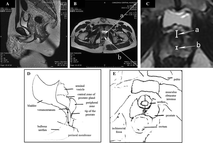 Normal anatomy of urethral sphincter complex in young Chinese males on ...