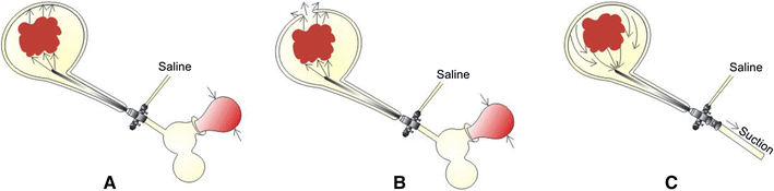 Mechanical suction for clot evacuation: experience with “suction bridge ...