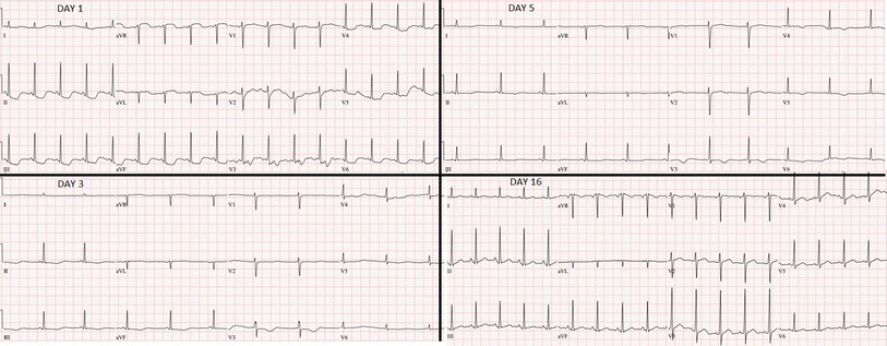 Extreme hypernatremia (254 mmol/L) and electrocardiogram findings ...
