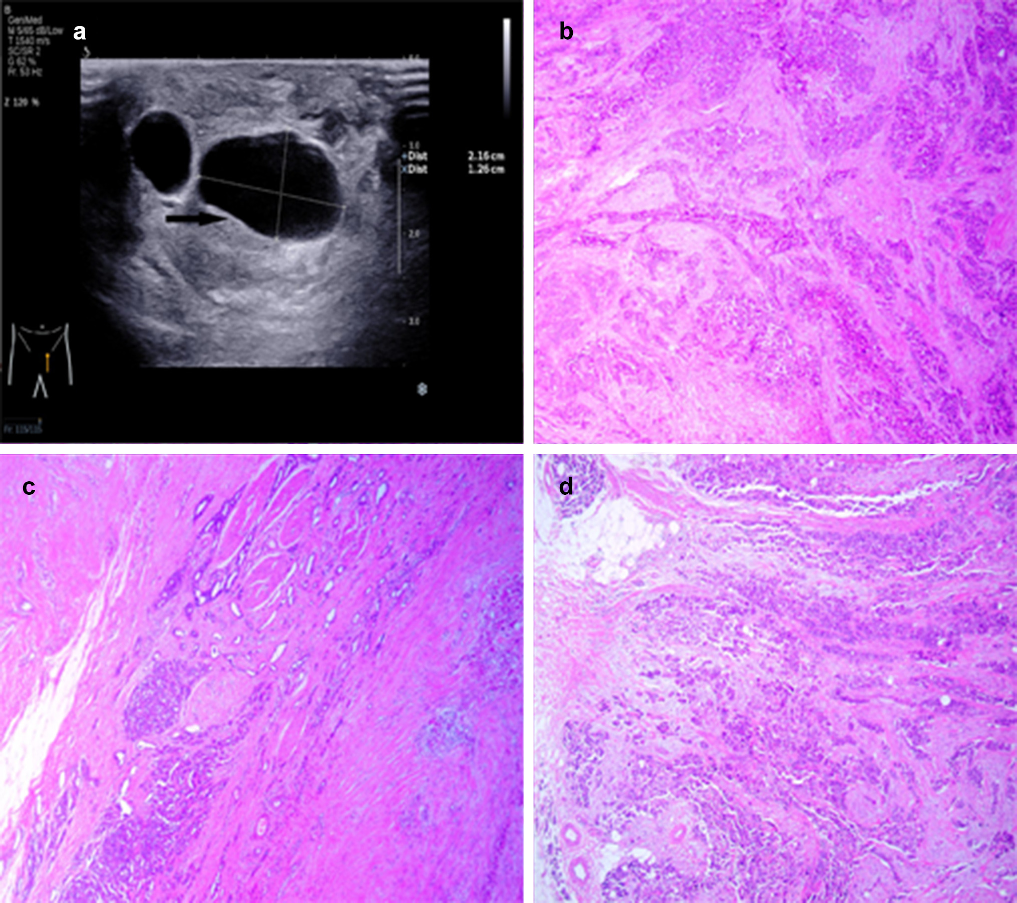 Case report of inguinal metastasis of epididymal malignant mesothelioma ...