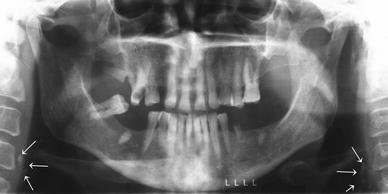 Incidental findings of carotid artery stenosis detected by ...