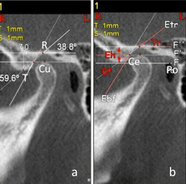 Associations between the articular eminence inclination and condylar ...
