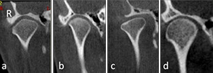 Associations between the articular eminence inclination and condylar ...