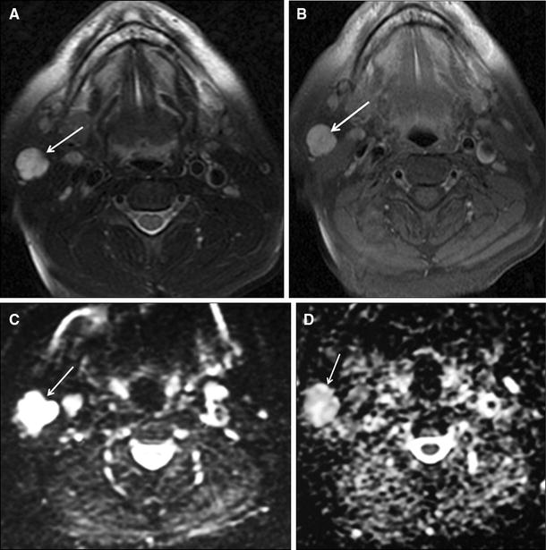 Parotid Gland Tumor Mri