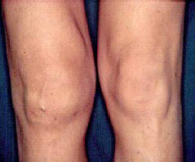 Diagnostik & Therapie der Lyme-Borreliose | SpringerLink