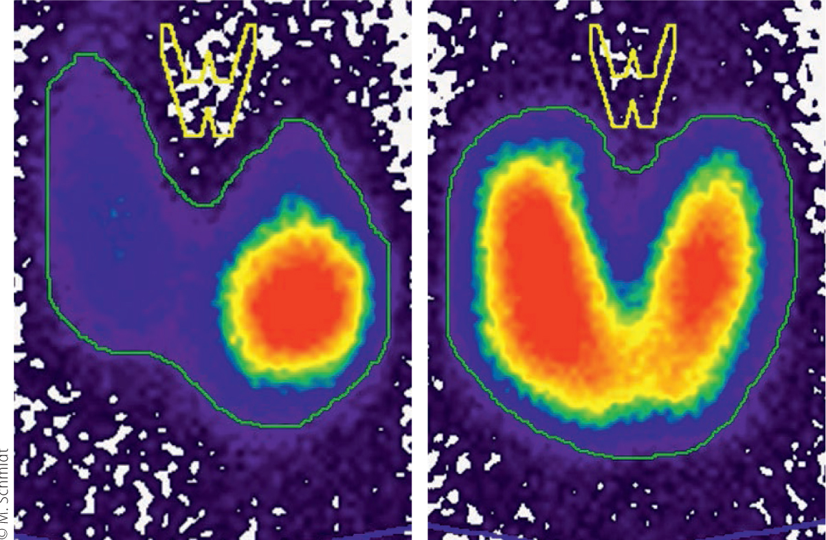 So erkennen und behandeln Sie die Hyperthyreose | SpringerLink