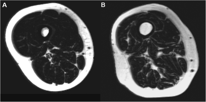 NMR imaging estimates of muscle volume and intramuscular fat ...