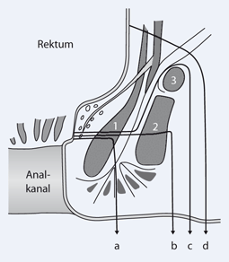 Fistelnder und abszedierender Morbus Crohn | SpringerLink