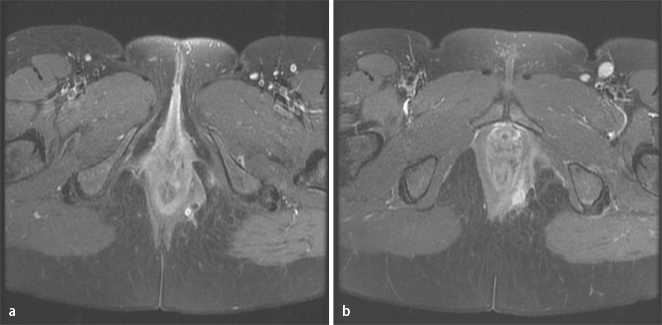 Pilonidalsinus und Analfistel | SpringerLink