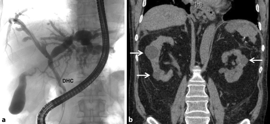 Angeborene Anomalien und Malformationen der Gallenwege | SpringerLink