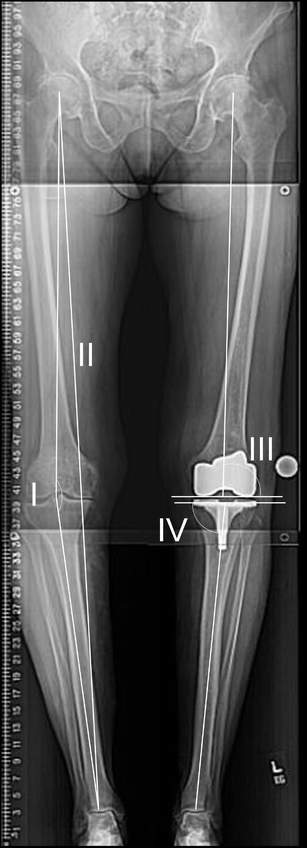 Varus Gonarthrosis Predisposes to Varus Malalignment in TKA | SpringerLink