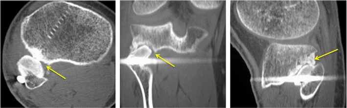 Successful Fusion of the Proximal Tibiofibular Joint with Osteogenic ...